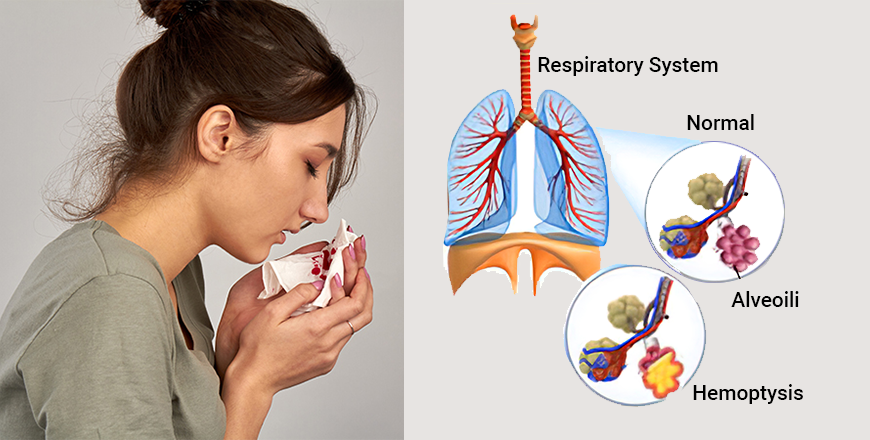 A journey to the core of lungs – Novel management for Hemoptysis